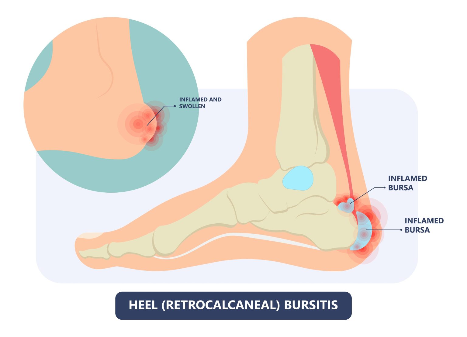 Achilles Bursitis - Rehab 49