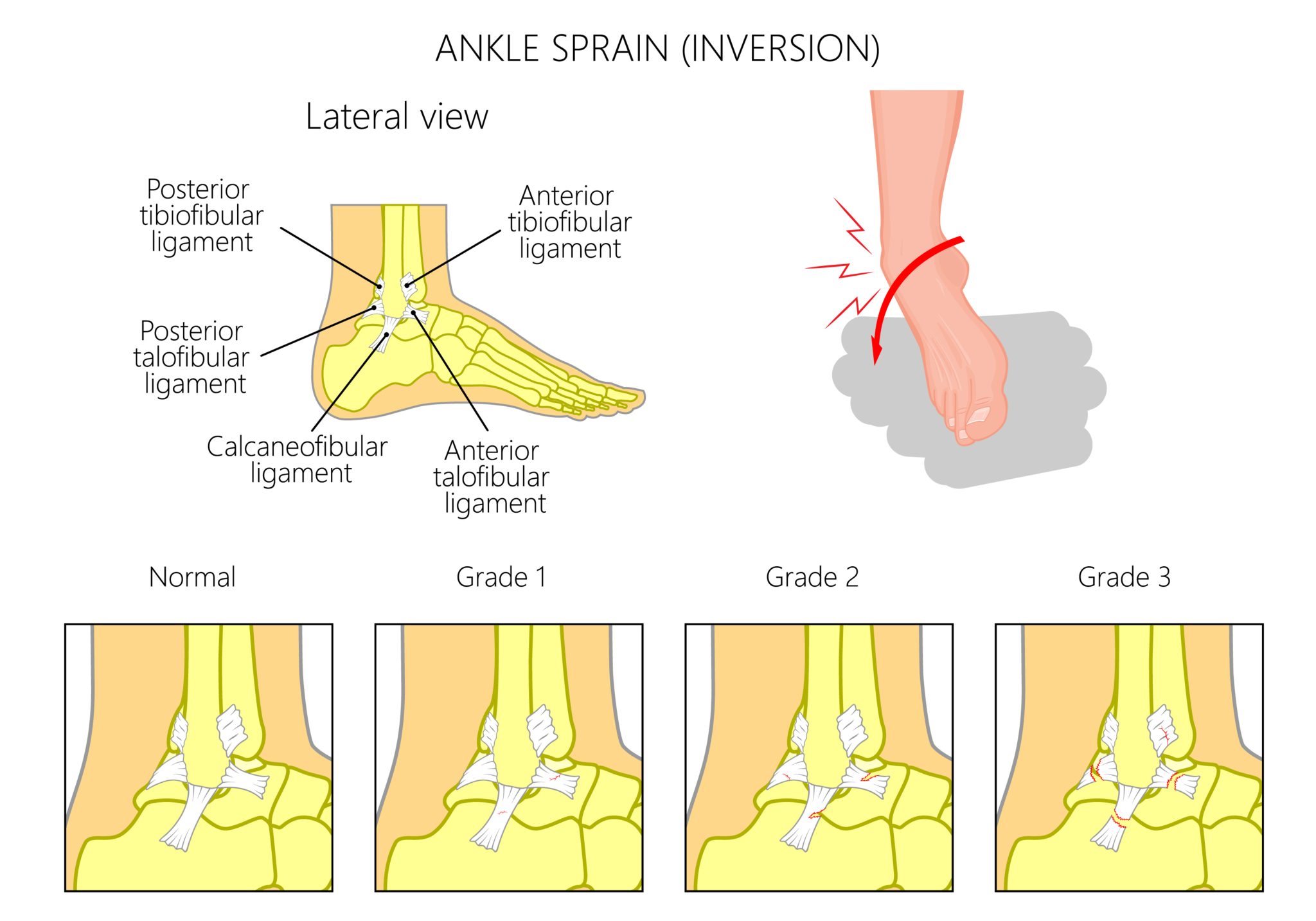 Ankle Injuries in Soccer - Rehab 49