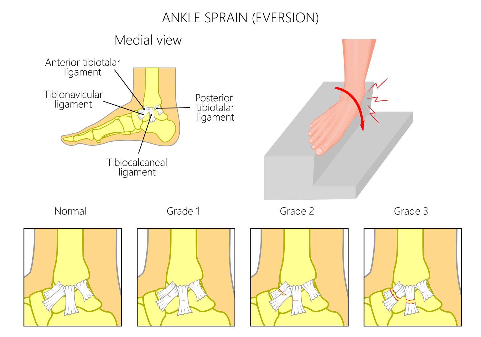Ankle Injuries in Soccer - Rehab 49