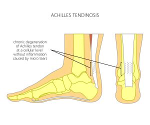 Physical Therapy for Achilles Tendonitis - Rehab 49