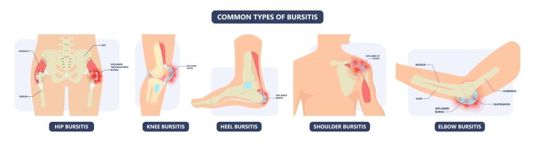Achilles Bursitis - Rehab 49