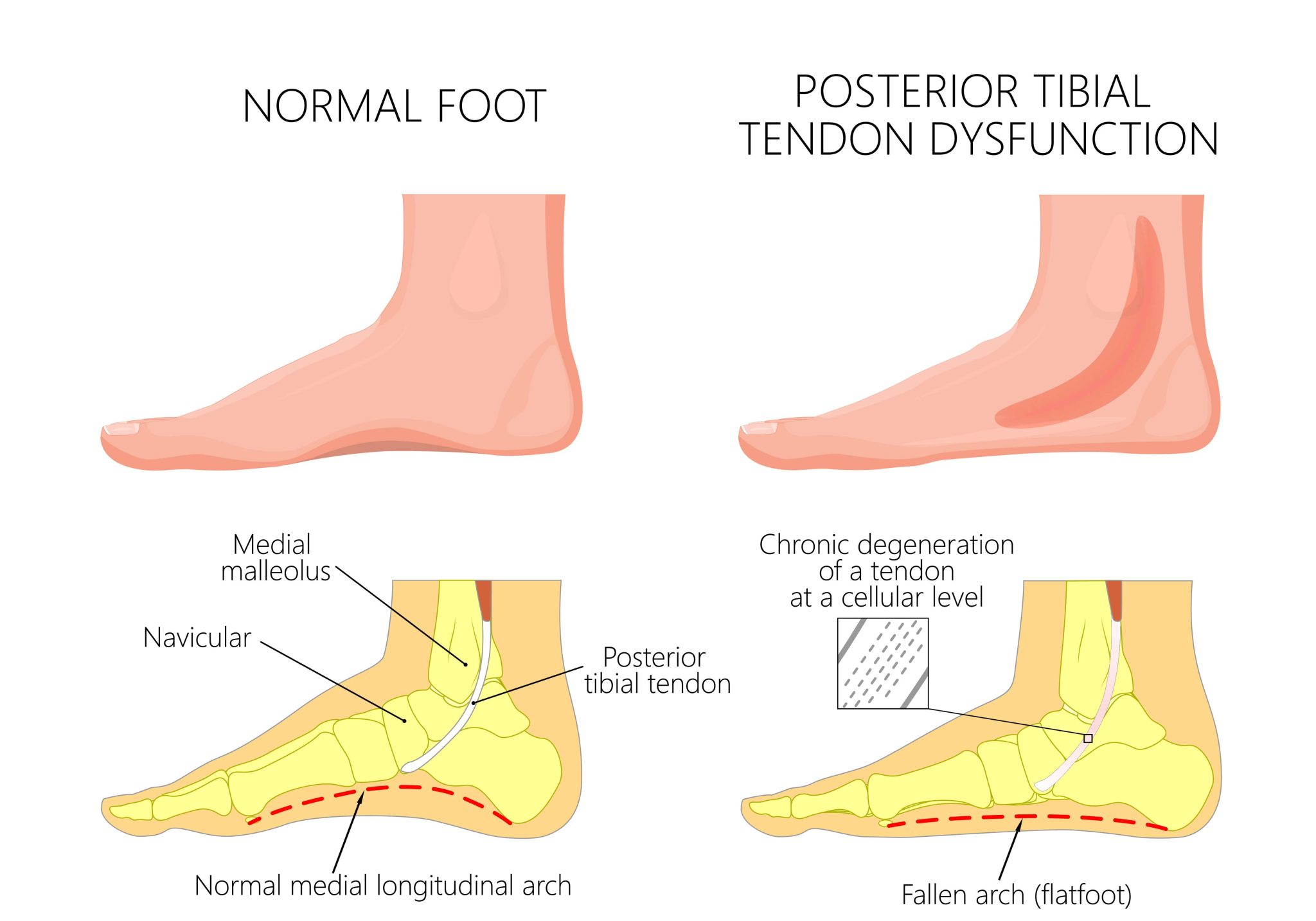 Foot Arch Pain (not plantar fasciitis) - Rehab 49