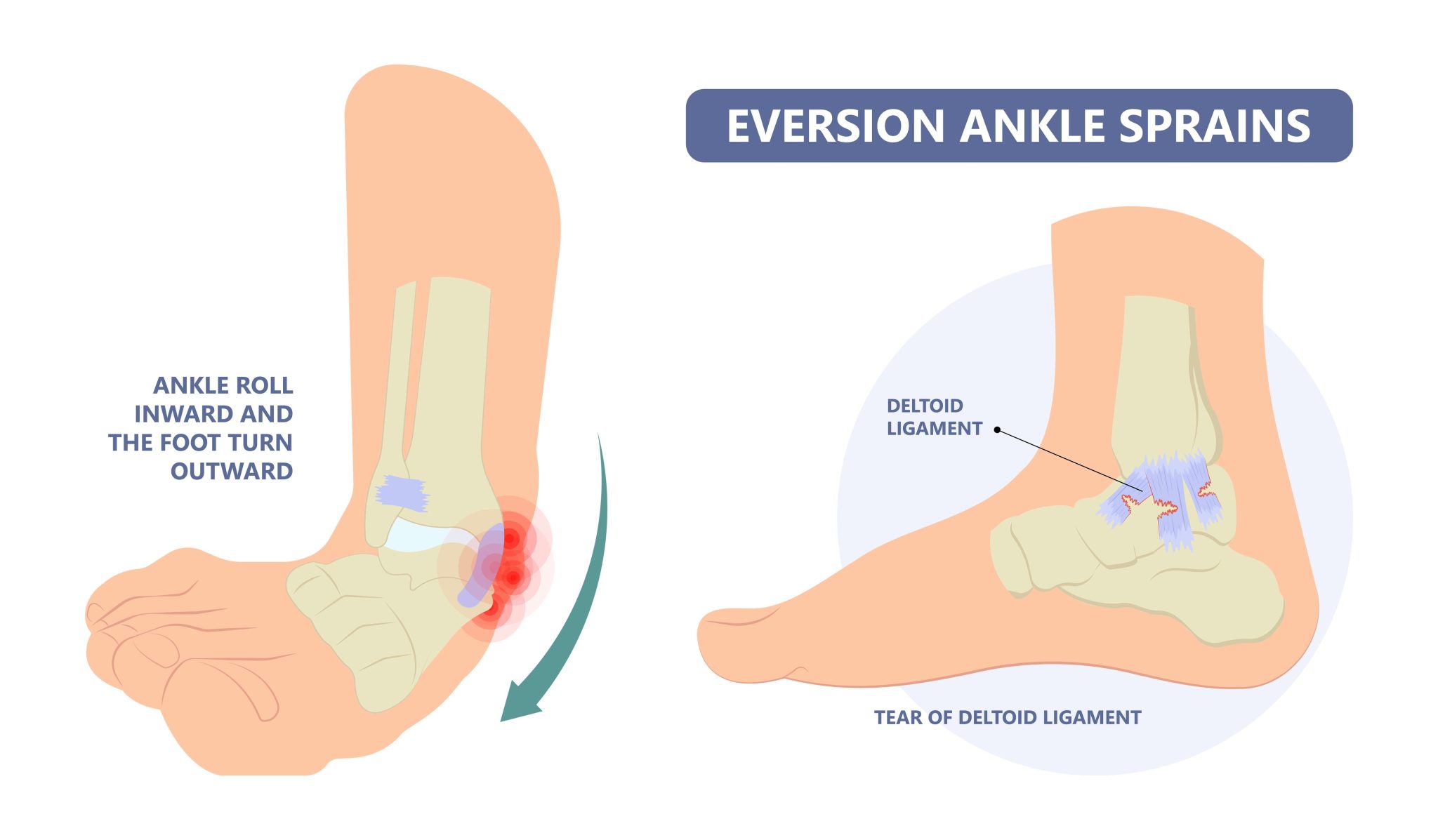 Ankle Injuries in Volleyball - Rehab 49