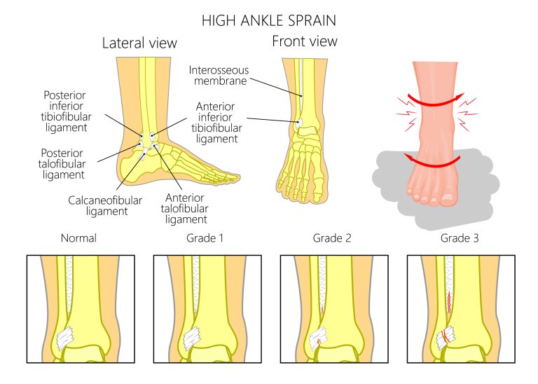 Achilles Pain After Ankle Sprain - Rehab 49