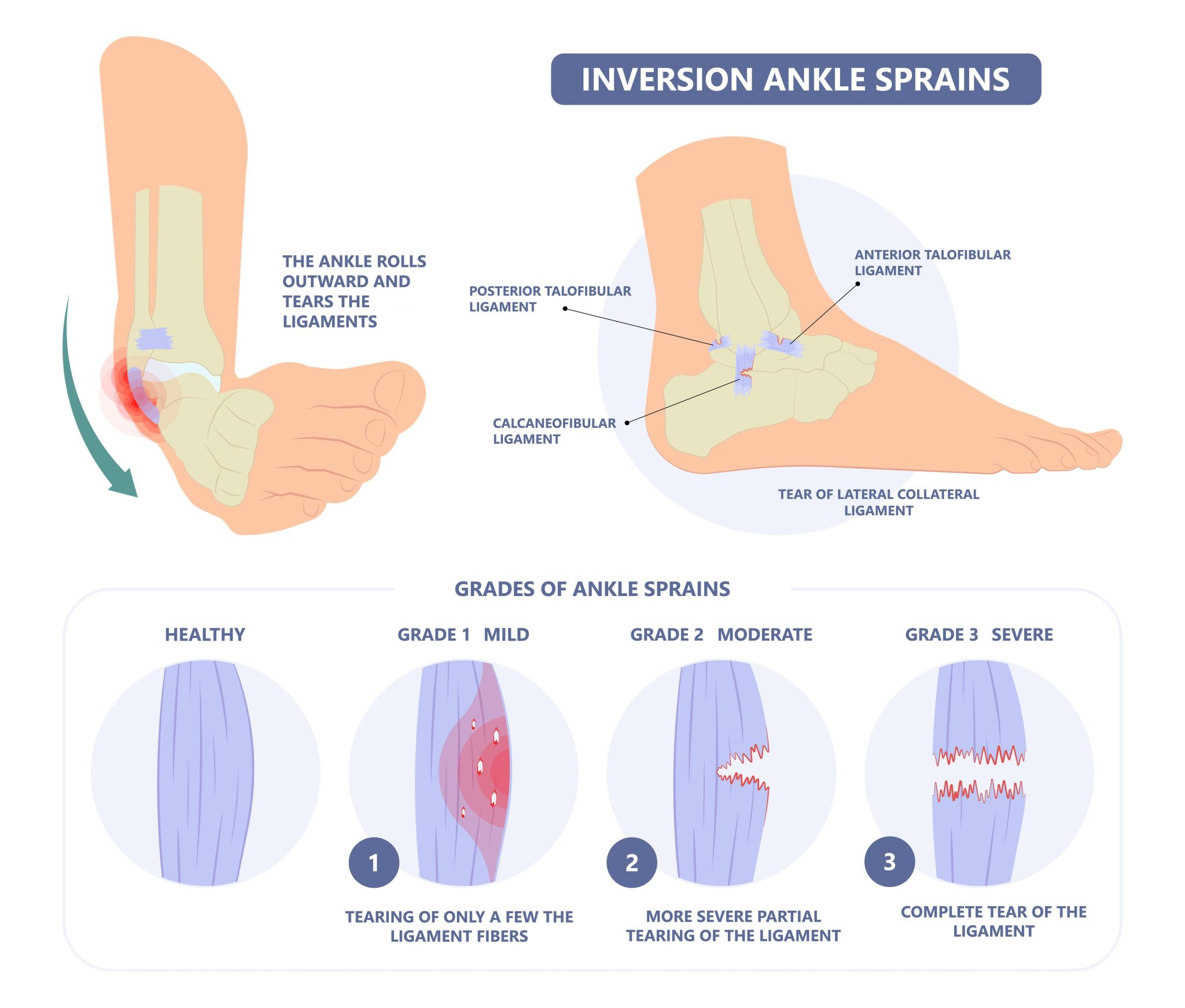 Understanding Chronic Ankle Sprains - Rehab 49