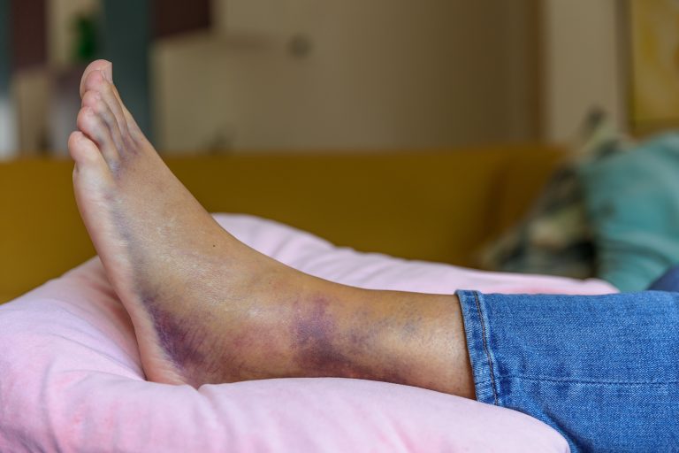 How to Sleep With a Sprained Ankle - Rehab 49