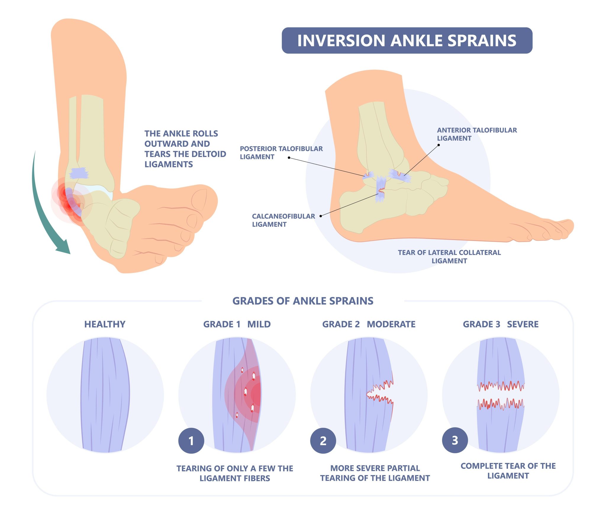 How Long Does a Sprained Ankle Stay Swollen? - Rehab 49