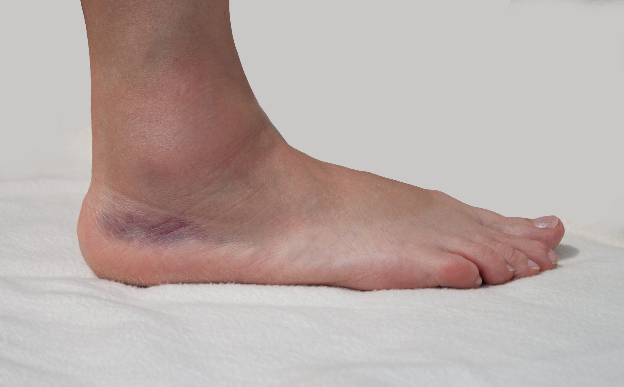 How Long Does a Sprained Ankle Stay Swollen? - Rehab 49