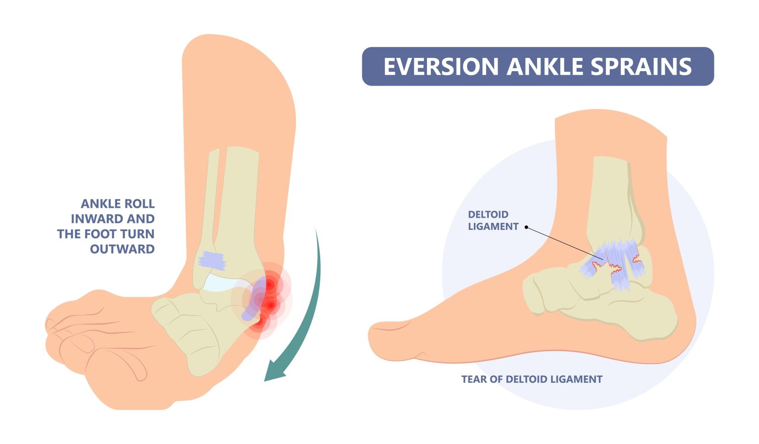 Low Ankle Sprain - Rehab 49