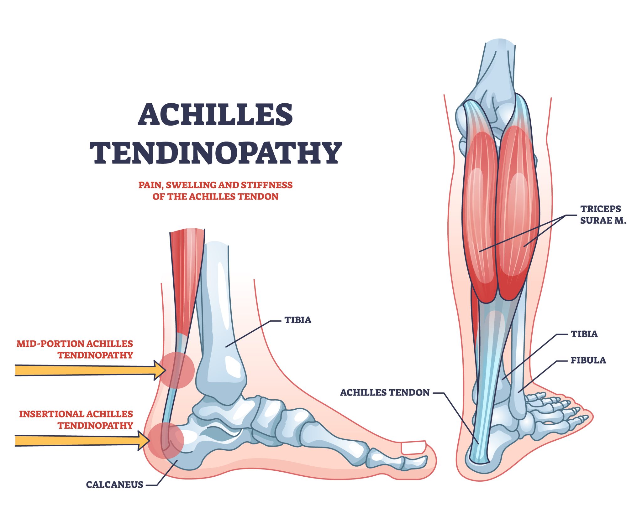 Thickened Achilles Tendon - Rehab 49
