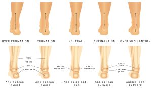 Overpronation and Knee Pain - Rehab 49