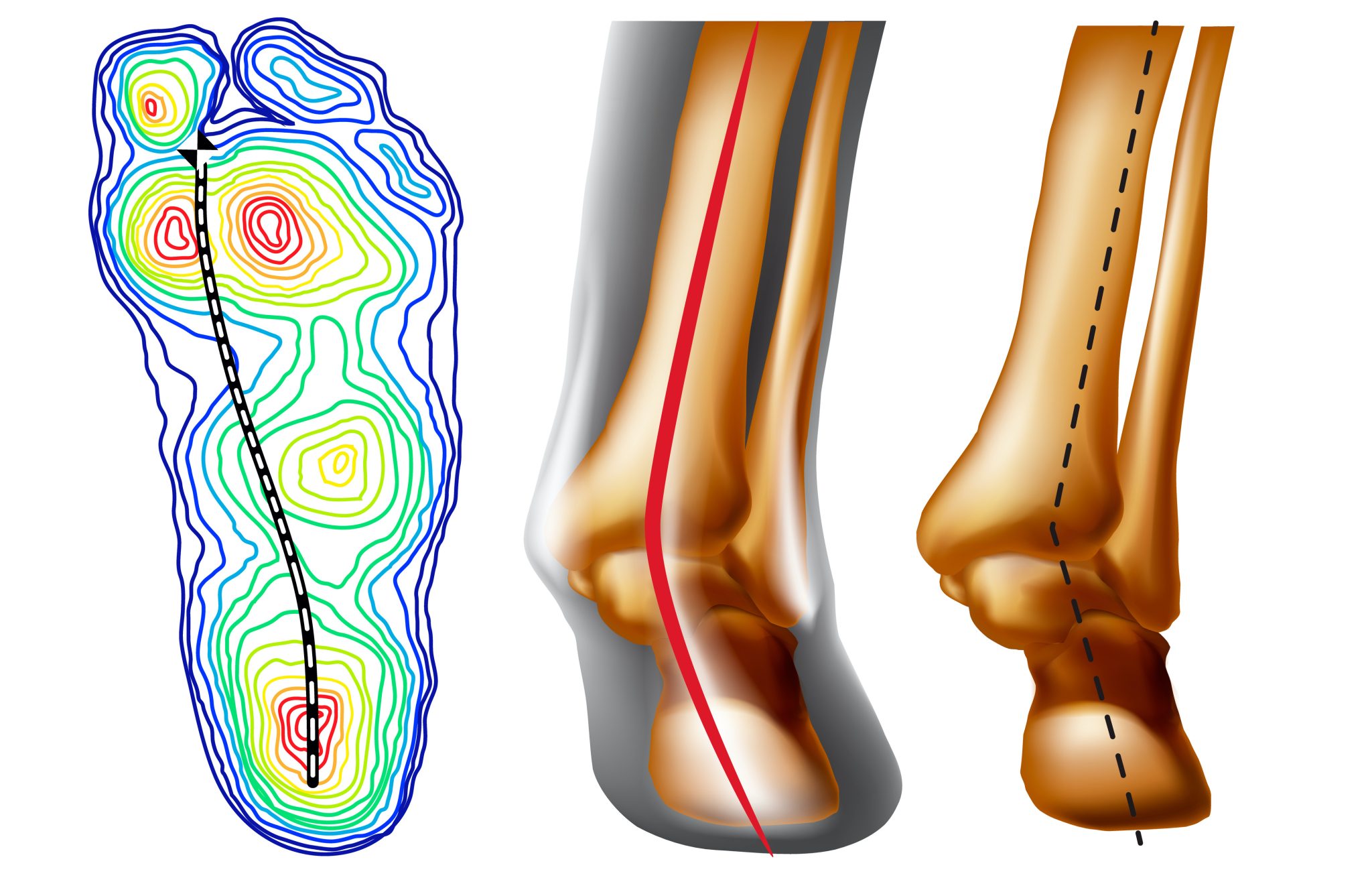 Overpronation and Knee Pain - Rehab 49